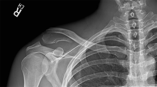 Recovering From a Broken Collarbone: Part 1 | TrainingPeaks